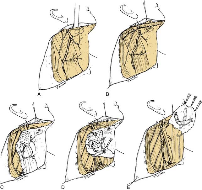 Neck Dissection Ento Key Neck Dissection Ento Key