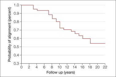 Intermittent Exotropia Ento Key
