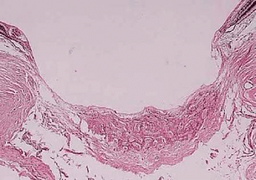 Pathology Of Glaucoma Ento Key
