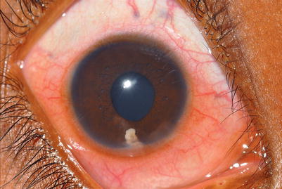 Ocular Parasitic Infections Ento Key