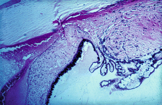 Vortex Vein Occlusion Ento Key