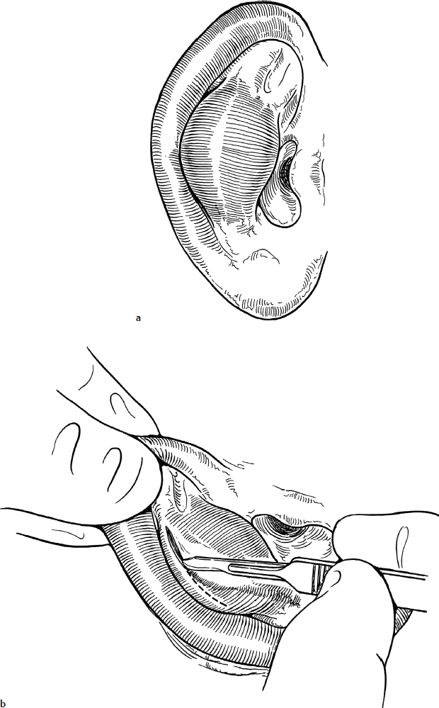 Ear Trauma Ento Key