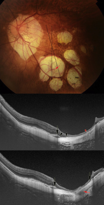 Macular Bruch Membrane Holes In Highly Myopic Patchy Chorioretinal