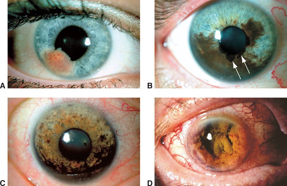 Melanocytic Tumors | Ento Key