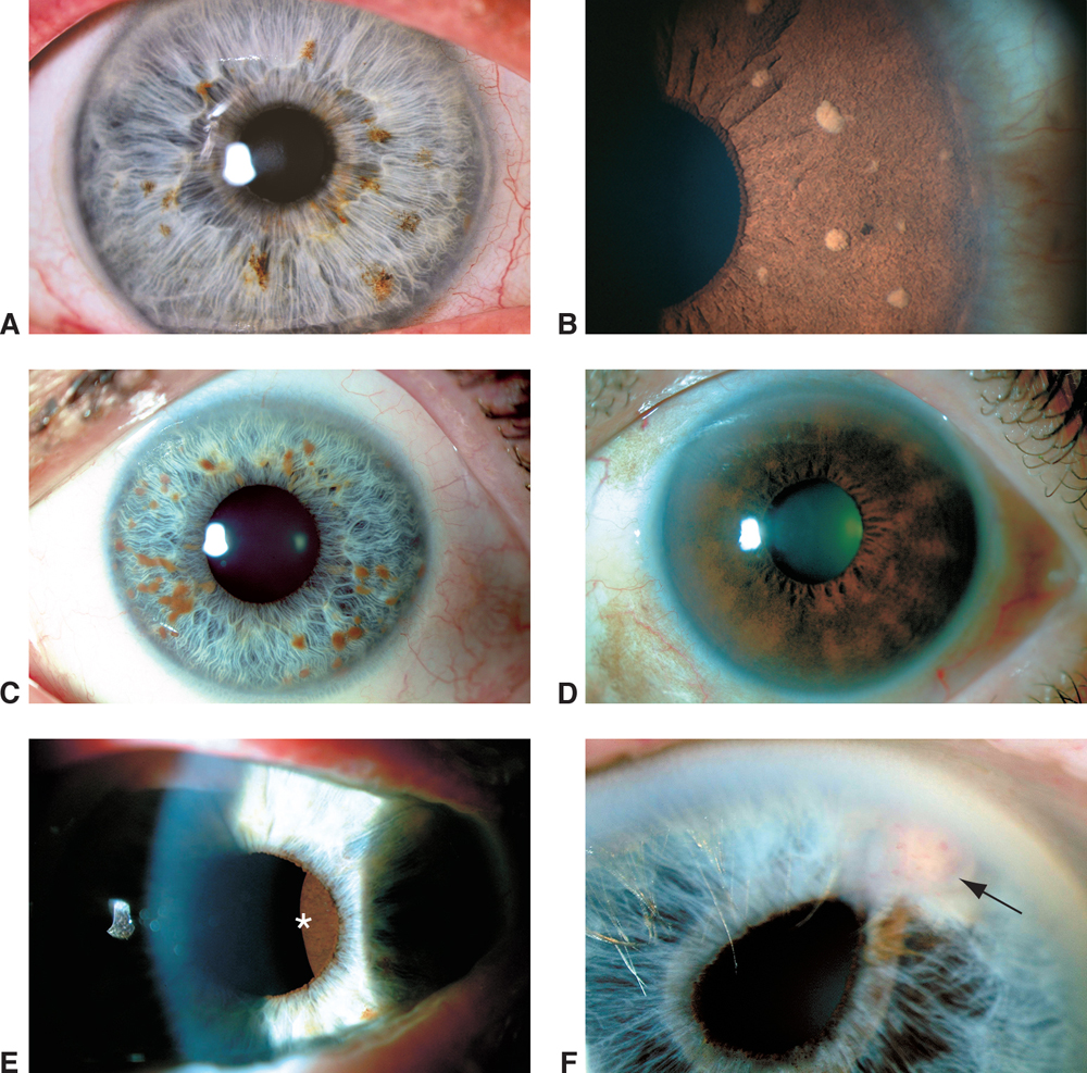 Melanocytic Tumors | Ento Key