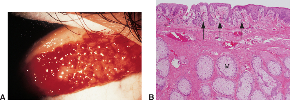 Follicular Vs Papillary Conjunctivitis