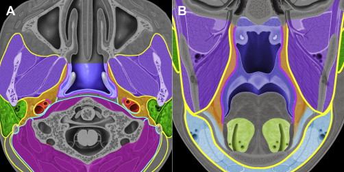 Imaging Evaluation of the Parapharyngeal Space | Ento Key