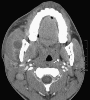 Imaging Evaluation of the Parapharyngeal Space | Ento Key
