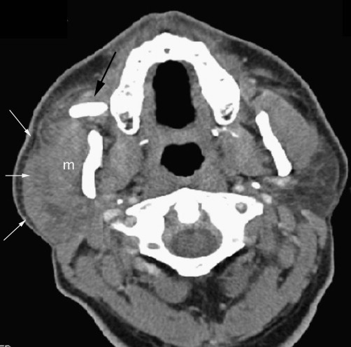 Masticator Space | Ento Key