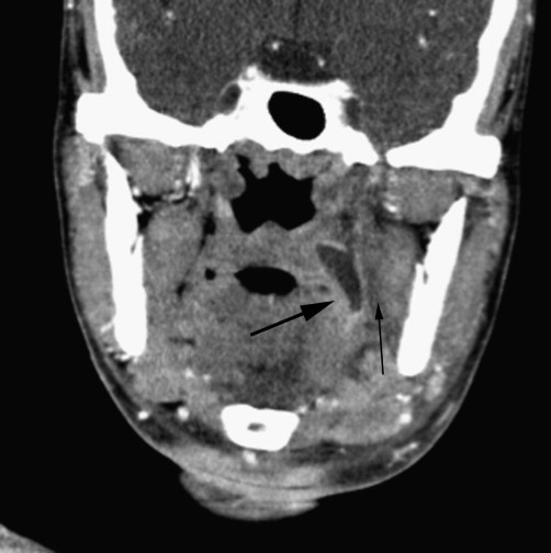 Masticator Space | Ento Key
