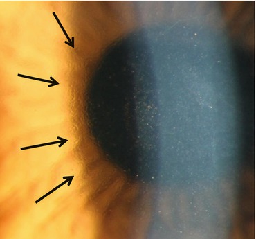 Clinical Phenotypes Of Fuchs Endothelial Corneal Dystrophy Fecd