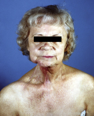 Radical Neck Dissection Ento Key