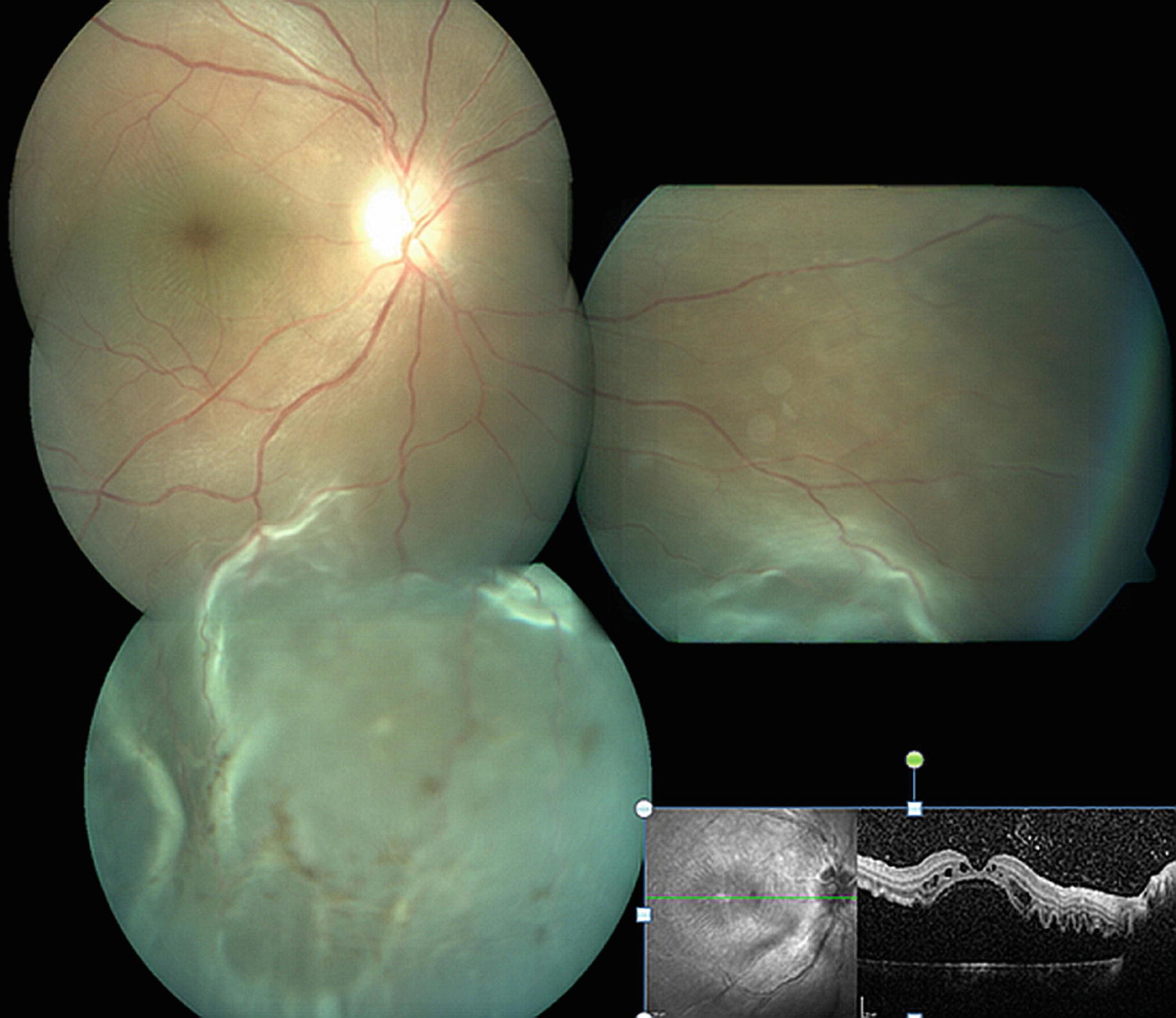 Uveitis Ento Key
