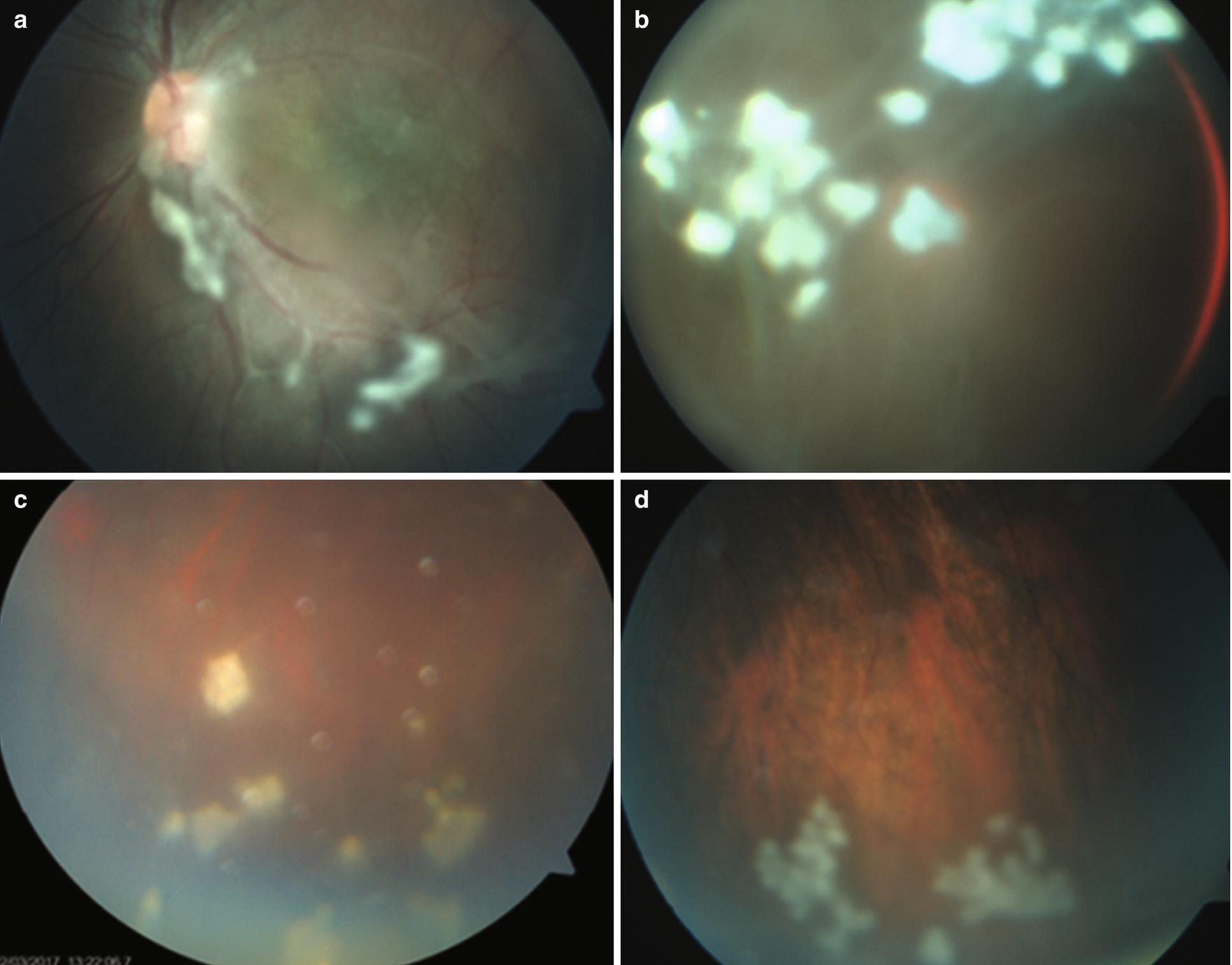 Uveitis Ento Key