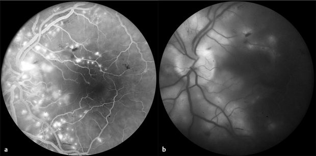 Cobblestone Degeneration