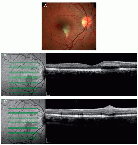 Paracentral Acute Middle Maculopathy Ento Key