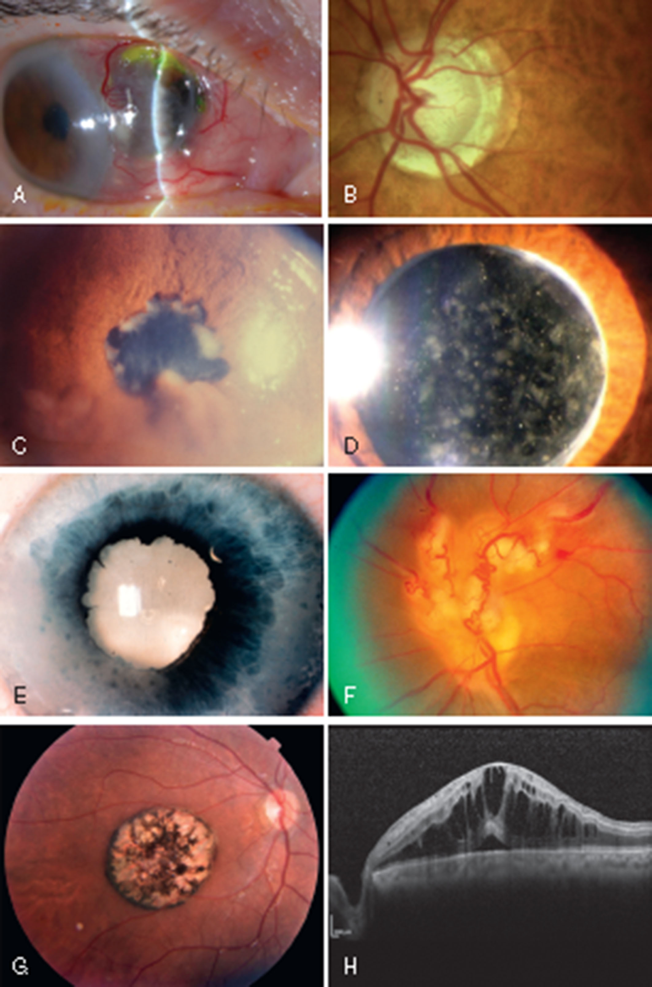 Uveitis Ento Key