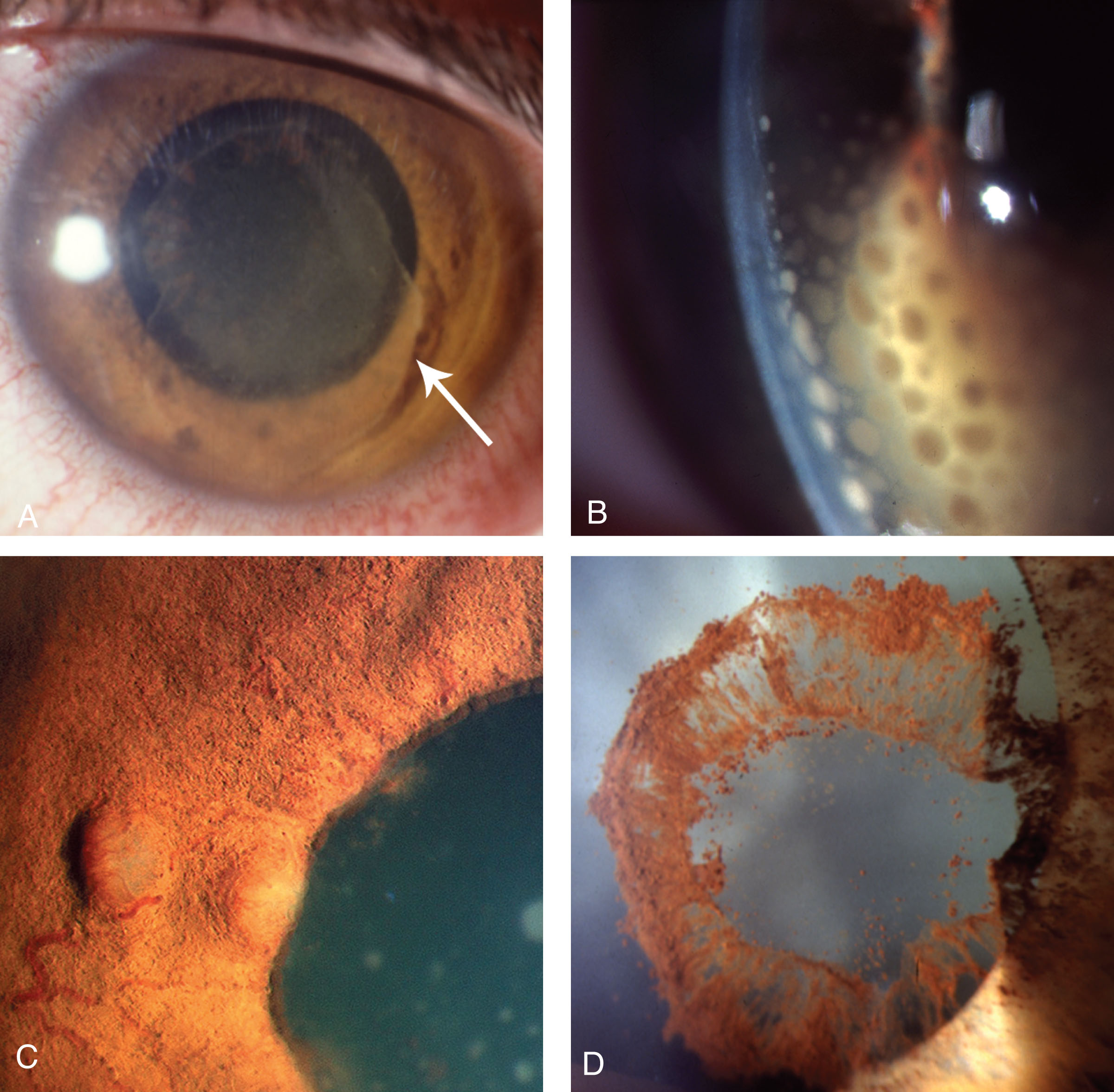 Uveitis Ento Key